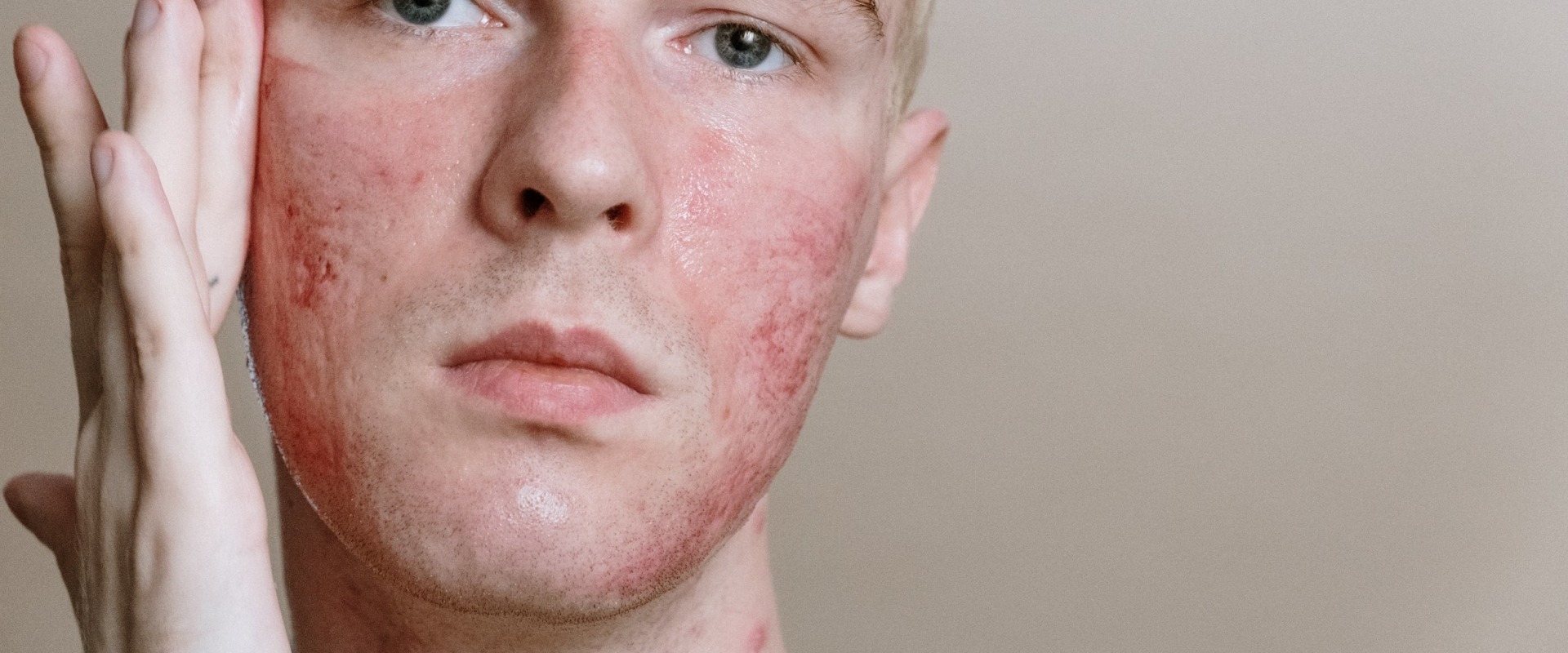 What is the most extreme acne treatment?